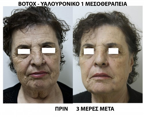 Μη Επεμβατικές Θεραπείες Προσώπου - Νεκτάριος Α.. Ντουντουλάκης